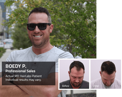 The Future of Hair Restoration